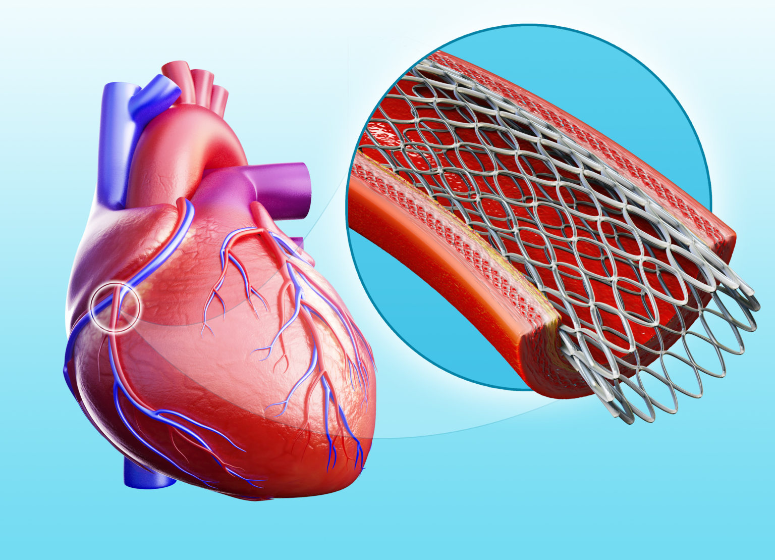 3d,Illustration,Of,Stent,Implantation,For,Supporting,Blood,Circulation ...